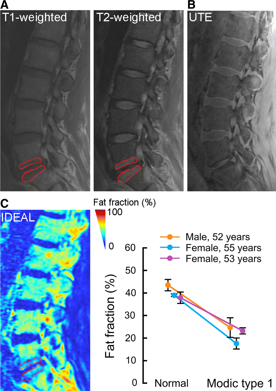 Measuring and reporting of vertebral endplate bone marrow lesions as ...