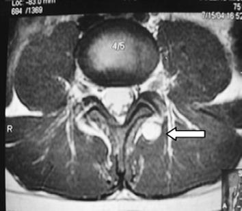 Ganglion cyst of a lumbar facet joint in an adolescent—a case report ...