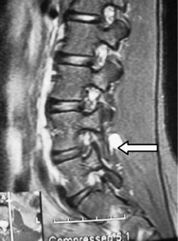 Ganglion cyst of a lumbar facet joint in an adolescent—a case report ...