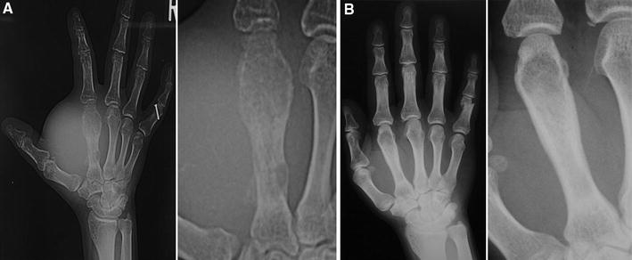 Chondrosarcoma of the hand: radiologic evaluation at early stage ...