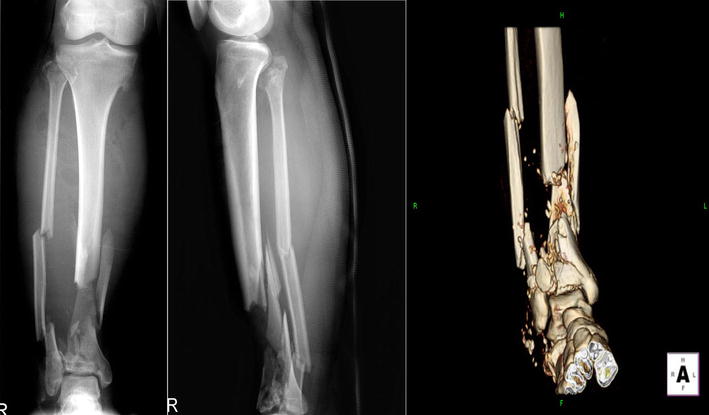 Surgical management of pilon fractures with large segmental bone ...