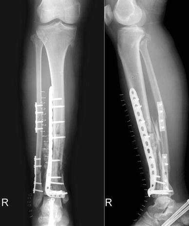 Surgical management of pilon fractures with large segmental bone ...