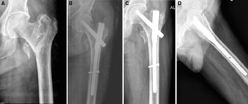 Proximal femoral nail antirotation (PFNA) for treatment of osteoporotic ...