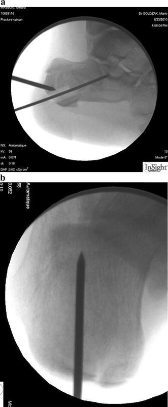 Locked nailing for the treatment of displaced articular fractures of ...