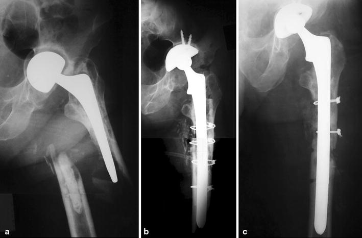 Management of Vancouver type B2 and B3 femoral periprosthetic fractures ...
