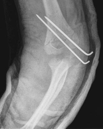 Evaluation and management of pulseless pink/pale hand syndrome ...