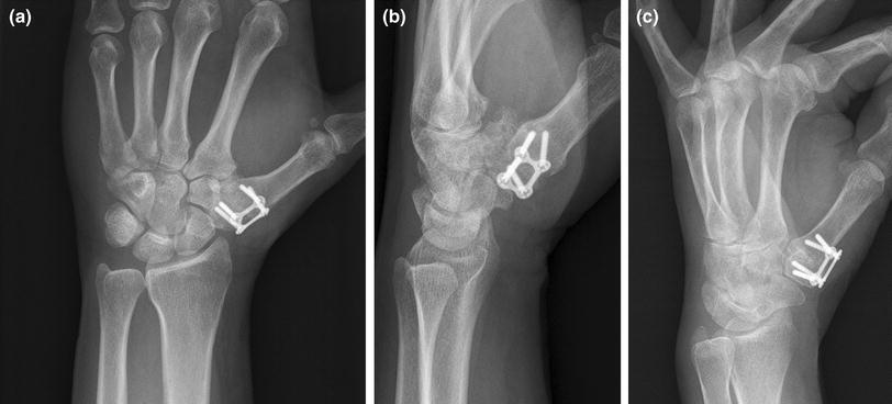 Arthrodesis of the thumb carpometacarpal joint using a quadrangular ...