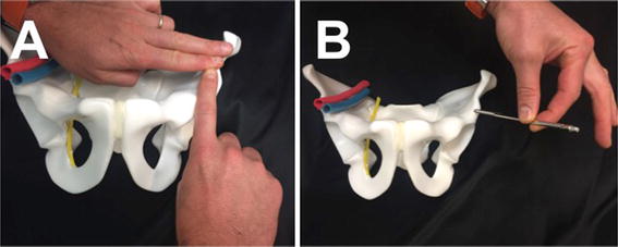Optimization of technique for insertion of implants at the supra ...