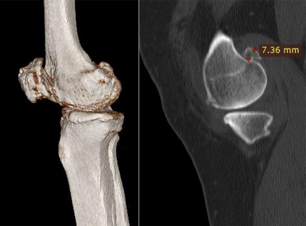 Effects of posterior condylar osteophytes on gap balancing in computer ...