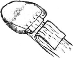 A new minimally invasive surgical technique for medial retinaculum ...