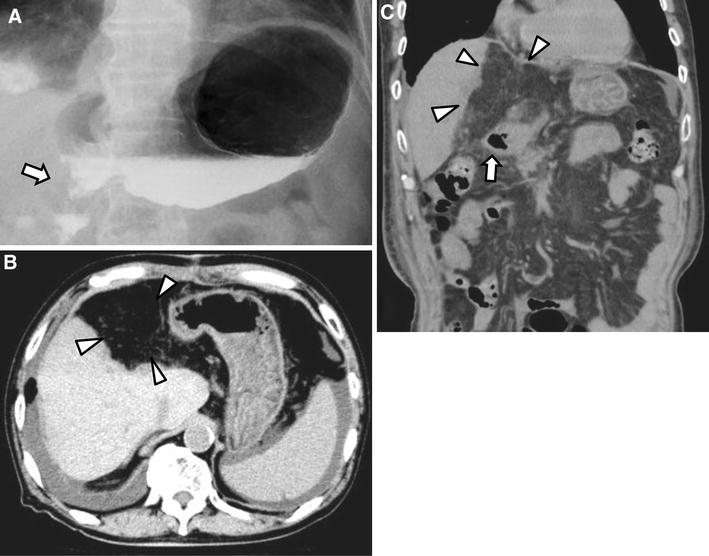 Omental flap wrapping with fixation to the cut surface of the liver for ...
