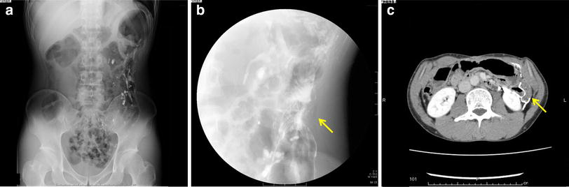 Anastomotic stenosis of the descending colon caused by barium granuloma ...