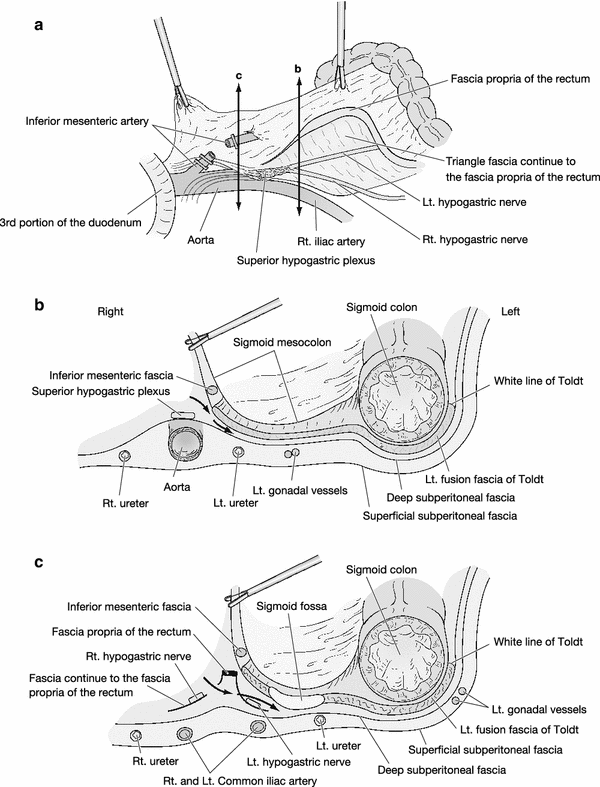 Laparoscopic surgery for colon cancer: a review of the fascial ...