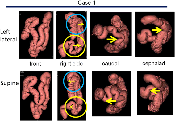 A novel physical colonoscopy simulator based on analysis of data from ...
