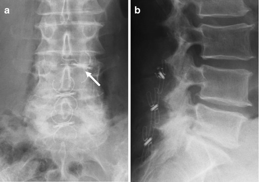 Safety and efficacy of a new percutaneously implantable interspinous ...