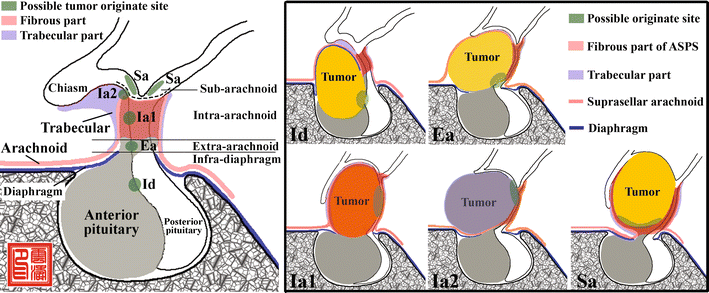 Anatomic relations of the arachnoidea around the pituitary stalk ...