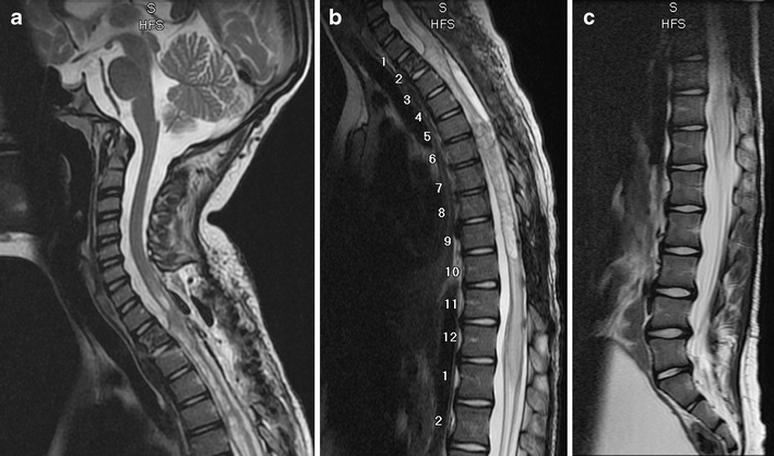Terminal ventriculostomy as an adjuvant treatment of complex ...