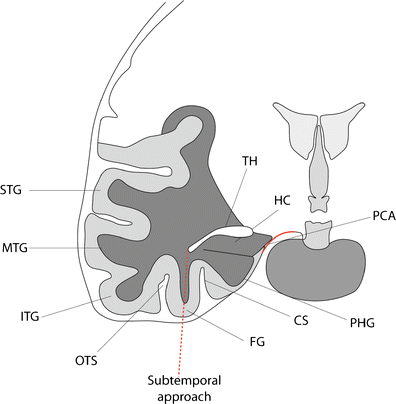 How I do it – selective amygdalohippocampectomy via subtemporal ...
