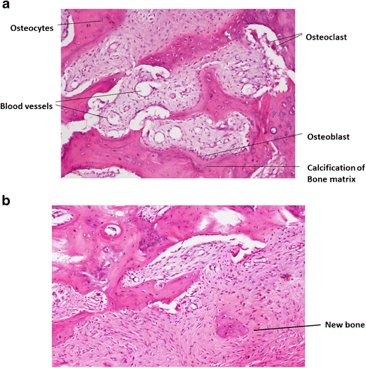 Histopathology of subcutaneously preserved autologous bone flap after ...