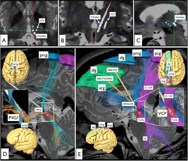 Diffusion tensor magnetic resonance imaging (DTI) tractography-guided ...