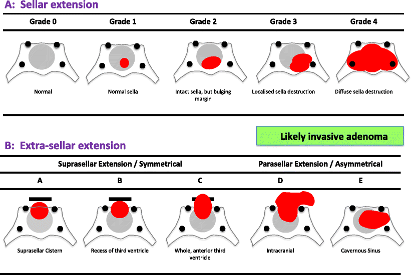 Assessing size of pituitary adenomas: a comparison of qualitative and ...