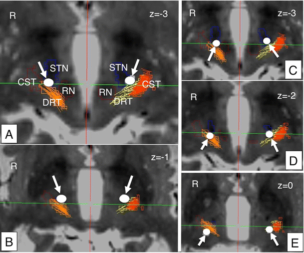 One-pass deep brain stimulation of dentato-rubro-thalamic tract and ...