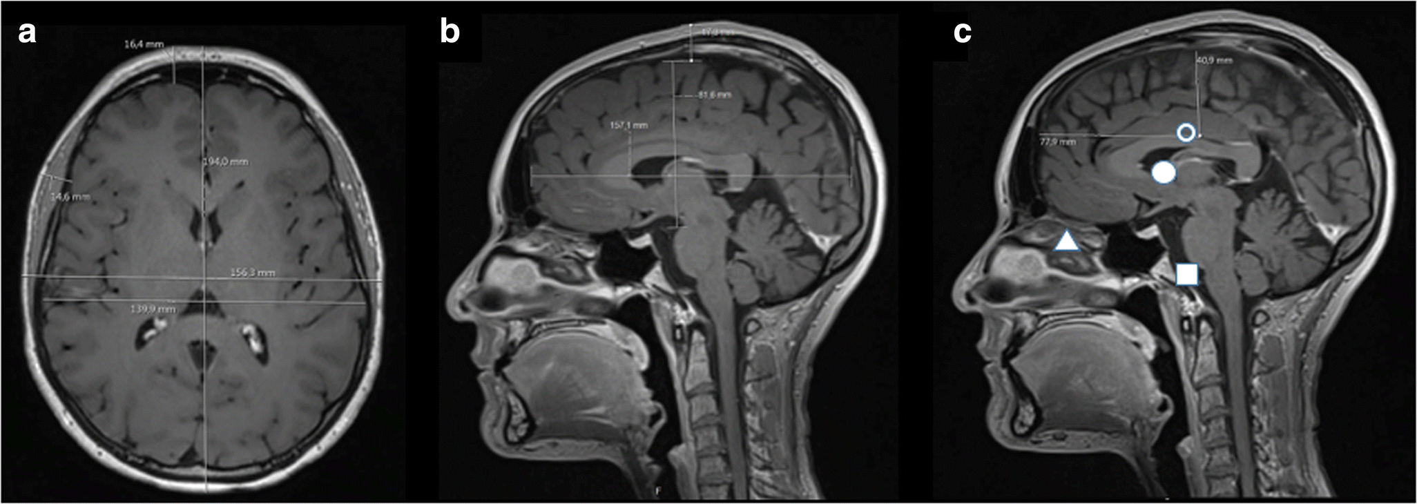 Best zero level for external ICP transducer | SpringerLink