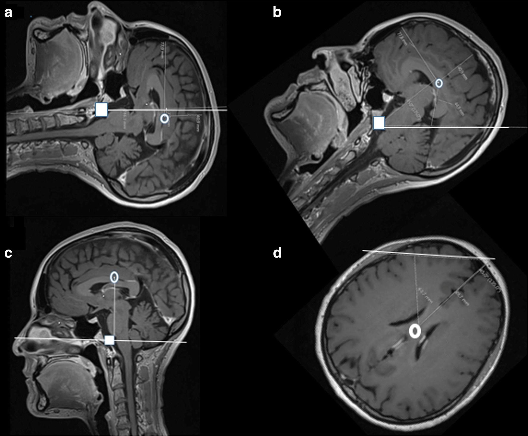 Best zero level for external ICP transducer | SpringerLink
