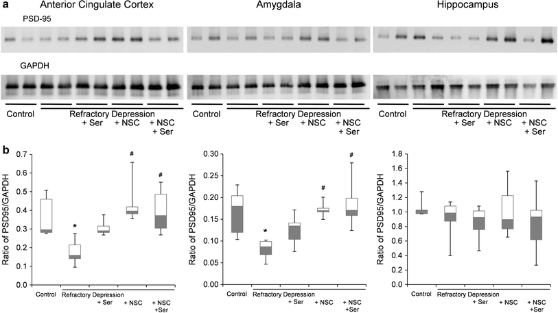 Stem cell therapy: a new approach to the treatment of refractory ...