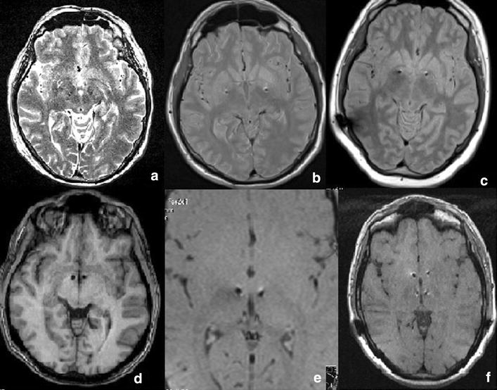 Why so many deep brain stimulation targets in Tourette’s syndrome ...