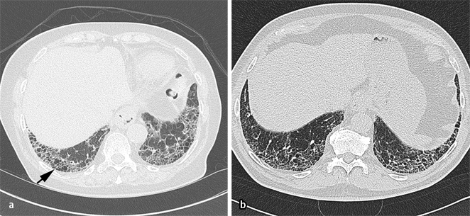 Klassische Muster pulmonaler Fibrosen | SpringerLink