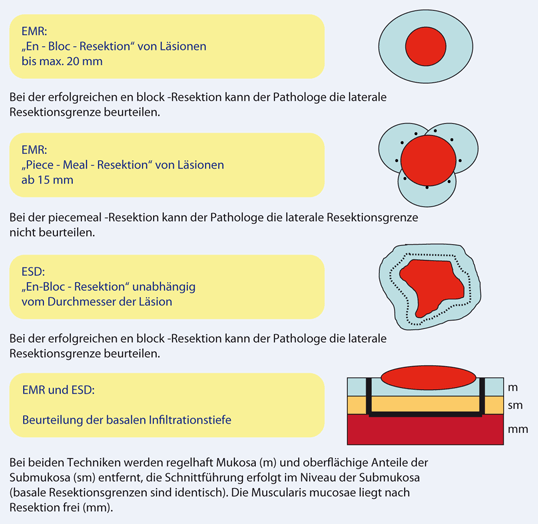 Endoskopische Resektion und minimal-invasive Verfahren beim Magenkarzinom | SpringerLink