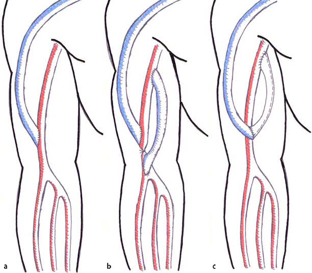 Stealsyndrom nach Dialysezugang | SpringerLink
