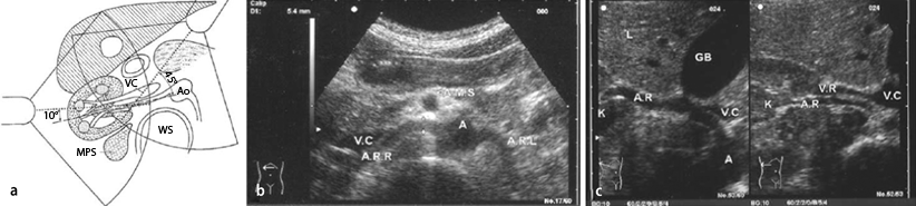 Ultraschalldiagnostik von Nierenarterienstenosen | SpringerLink