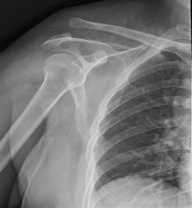 Acromio-clavicular dislocation with coraco-clavicular ligament ...