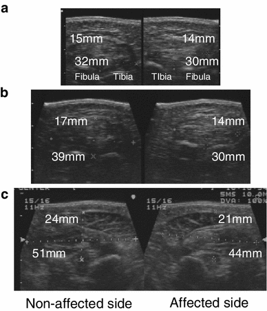 Effect of Achilles tenotomy on congenital clubfoot-associated calf ...