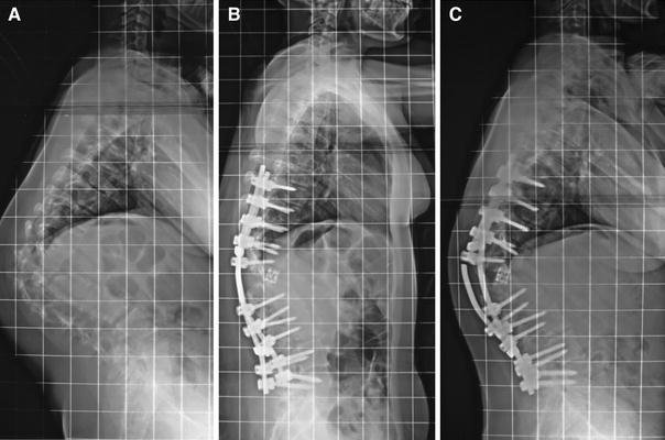 Rod fracture after long construct fusion for spinal deformity: clinical ...