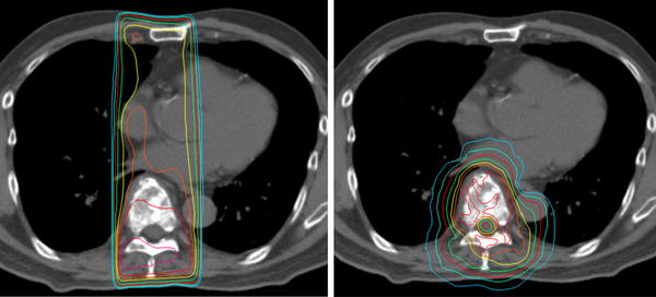 The current status and future of radiotherapy for spinal bone ...