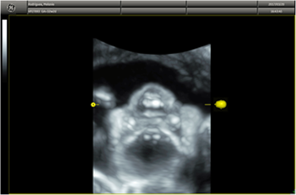 Fetal dental panorama on three-dimensional ultrasound imaging of cleft ...