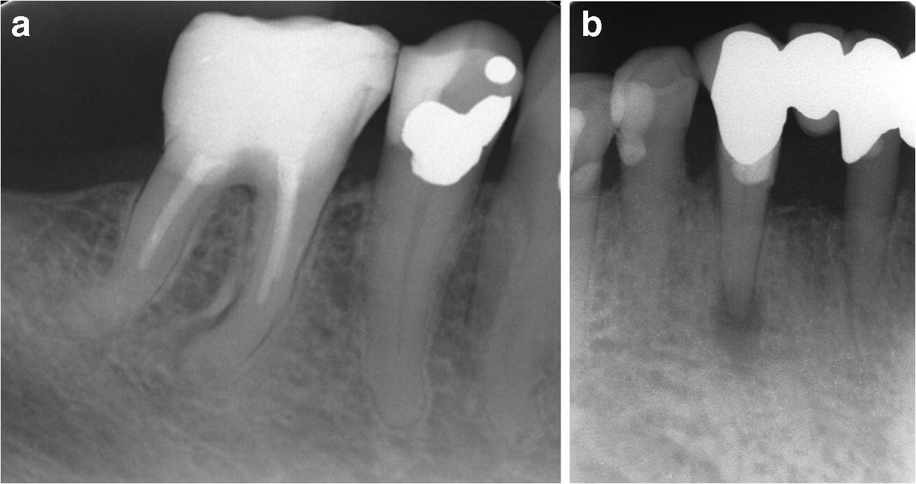 Apical periodontitis as potential source of infection in patients with ...