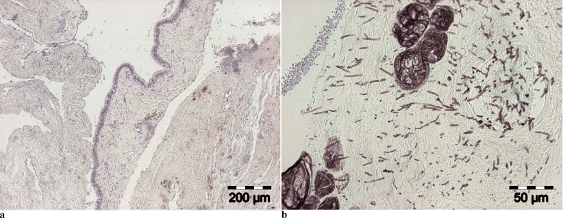 Allergische Pilzsinusitis, Fungusball und invasive Mykose der ...