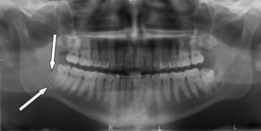 The clinical relevance of bifid and trifid mandibular canals | SpringerLink