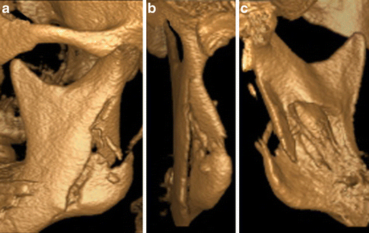 Risk factors and prevention of bad splits during sagittal split ...