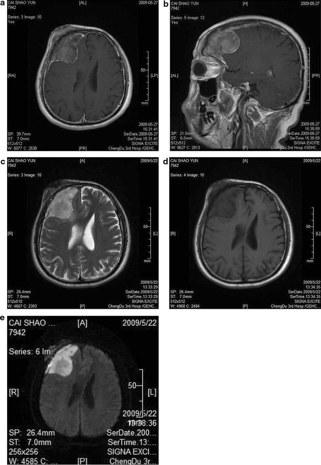 A meningioma with peripheral rim enhancement on MRI | SpringerLink
