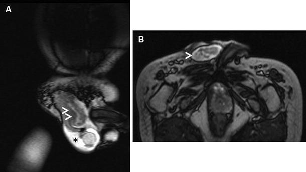 True-FISP MRI in diagnosis of postoperative hernia recurrence: a brief ...