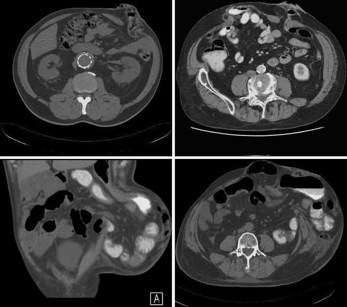 European Hernia Society classification of parastomal hernias | SpringerLink
