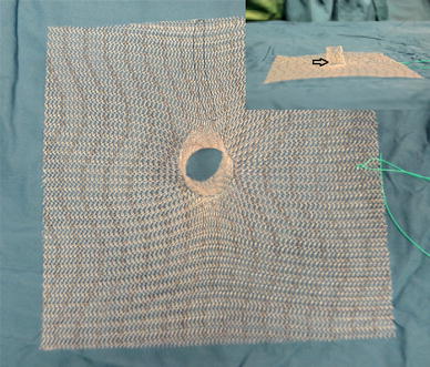 Prevention of parastomal hernias with 3D funnel meshes in ...