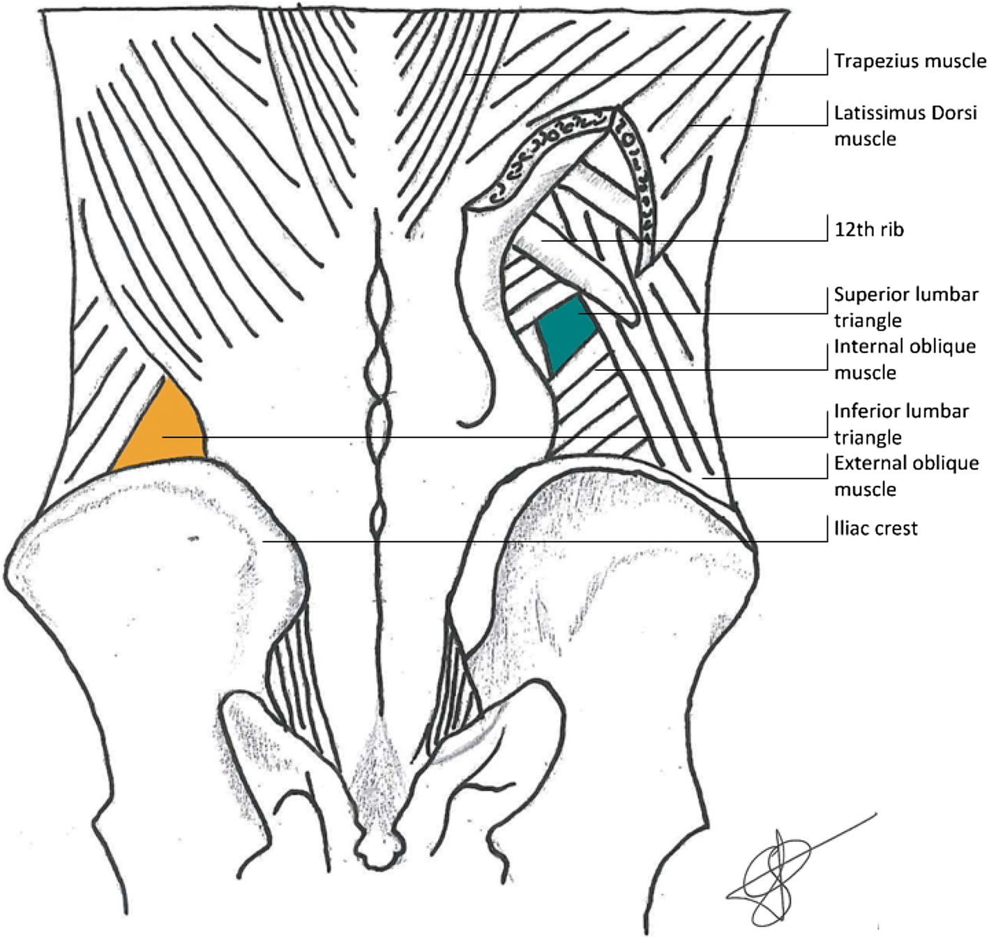 Pitfalls and clinical recommendations for the primary lumbar hernia ...