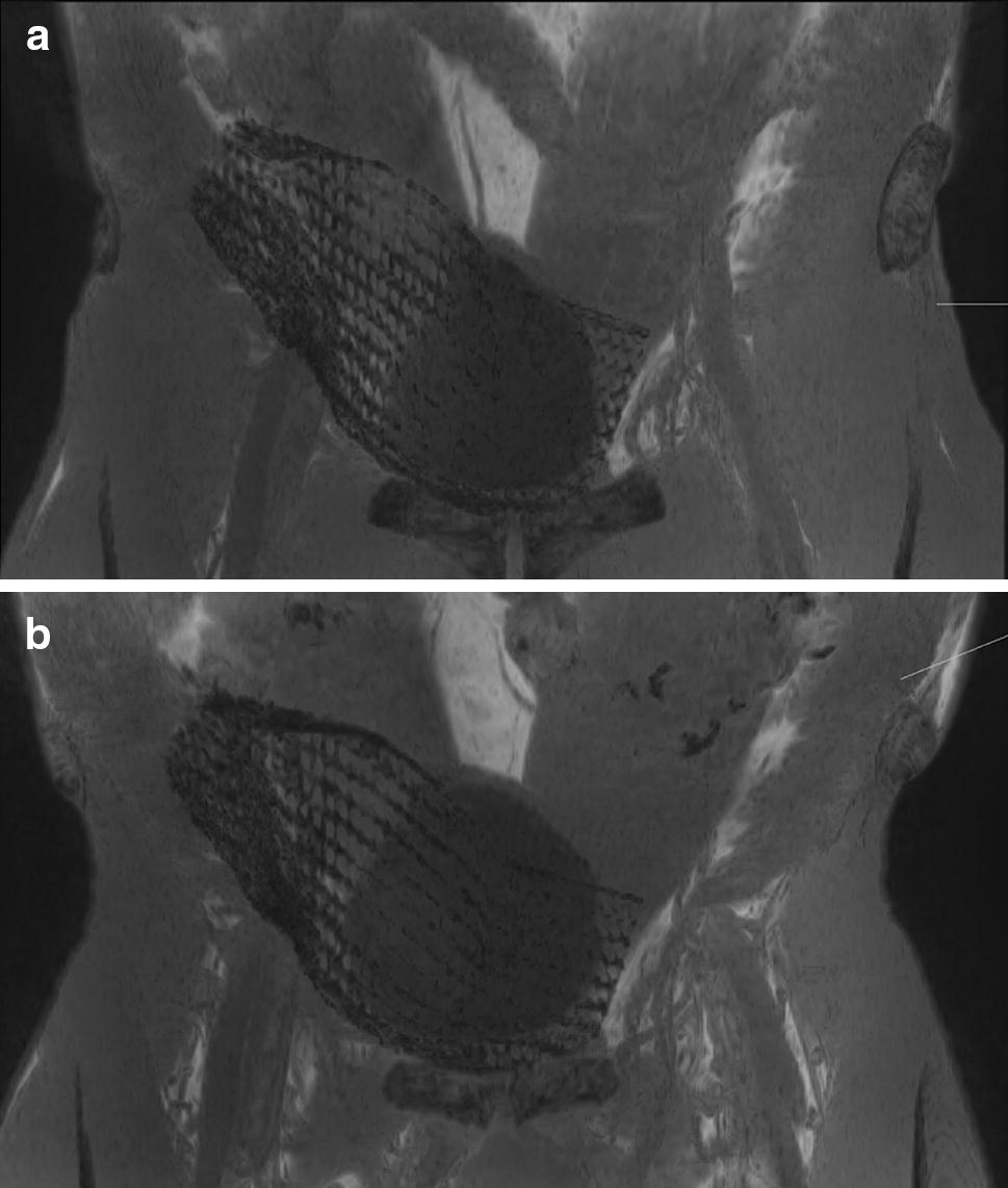 Surgical and radiological behavior of MRI-depictable mesh implants ...