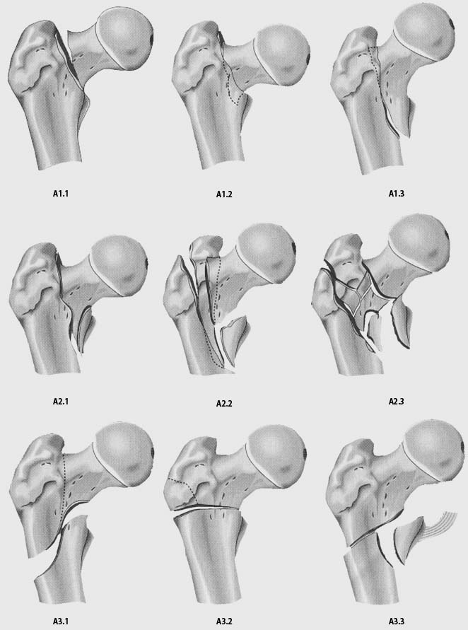Fraktur am proximalen Femur | SpringerLink